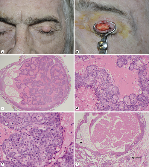 Sebaceoma of a Meibomian Gland of the Upper Eyelid | Ocular Oncology ...