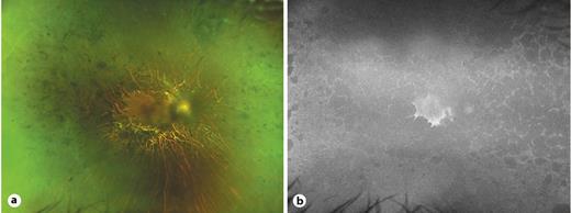 Iris Melanoma in a Patient with Retinitis Pigmentosa | Ocular Oncology ...