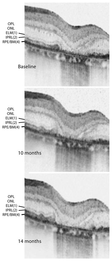 Imaging Geographic Atrophy in Age-Related Macular Degeneration ...