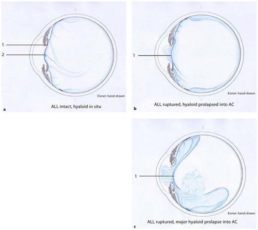 Retinal Complications after Damaging the Vitreolenticular Barrier ...