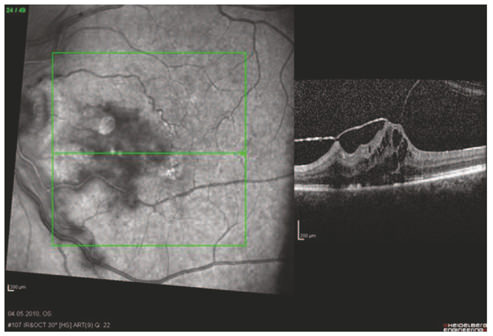 Retinal Complications after Damaging the Vitreolenticular Barrier ...