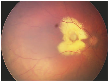 Diagnosis and Treatment of Coats’ Disease: A Review of the Literature ...