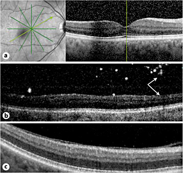 The Vitreous, the Retinal Interface in Ocular Health and Disease ...
