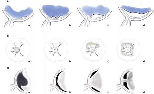 The Vitreous, the Retinal Interface in Ocular Health and Disease ...