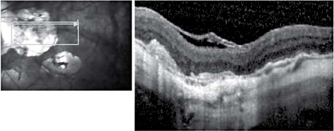 The Vitreous, the Retinal Interface in Ocular Health and Disease ...