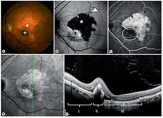 Retinal Pigment Epithelium Tears: Risk Factors, Mechanism and ...