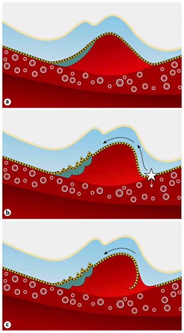 Retinal Pigment Epithelium Tears: Risk Factors, Mechanism and ...