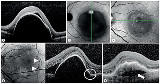 Retinal Pigment Epithelium Tears: Risk Factors, Mechanism and ...