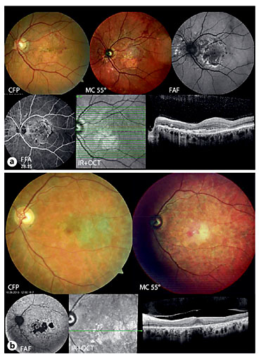 Clinical Application of Multicolor Imaging Technology | Ophthalmologica ...
