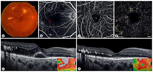 Guidelines for the Management of Diabetic Macular Edema by the European ...