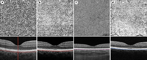 Optical Coherence Tomography Angiography Offers New Insights into ...