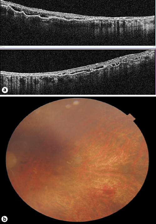 Retinal Toxicity of Medical Devices Used during Vitreoretinal Surgery ...