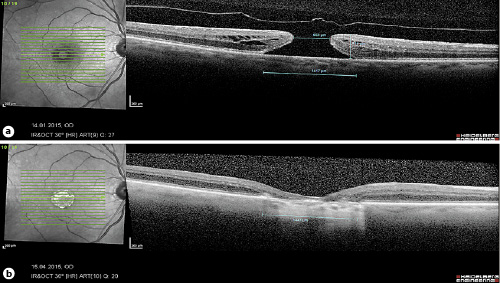 Retinal Toxicity of Medical Devices Used during Vitreoretinal Surgery ...