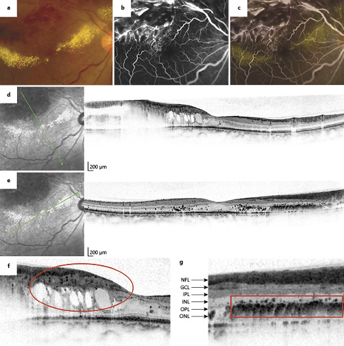 Guidelines for the Management of Retinal Vein Occlusion by the European ...