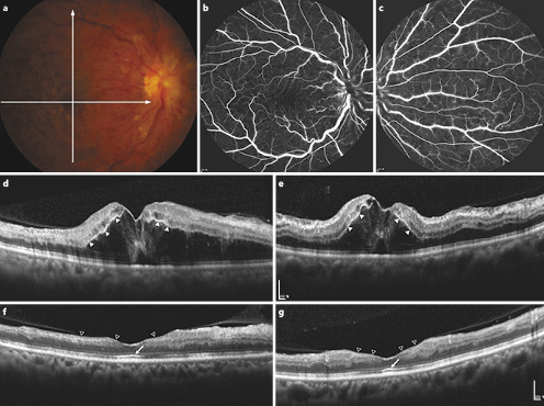 Guidelines for the Management of Retinal Vein Occlusion by the European ...