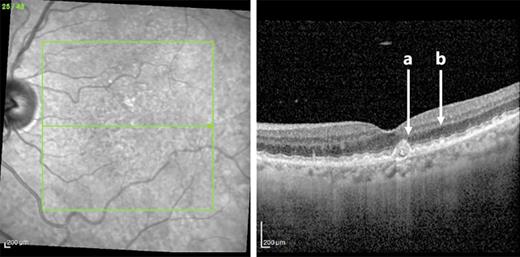Age-Related Macular Degeneration: Pathophysiology, Management, and ...