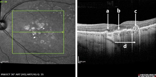 Age-Related Macular Degeneration: Pathophysiology, Management, and ...