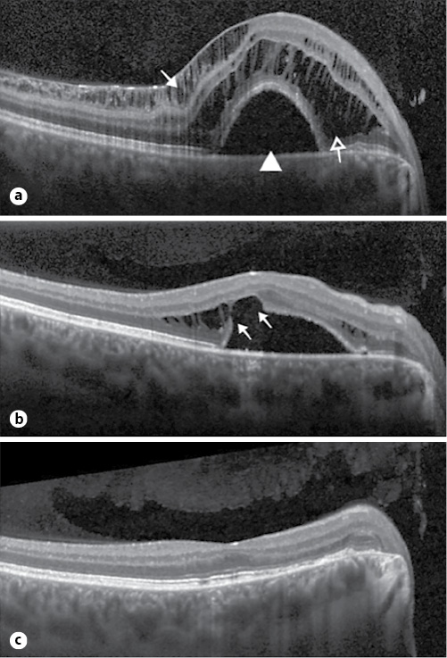 Natural Course of Optic Disc Pit Maculopathy: An Optical Coherence ...