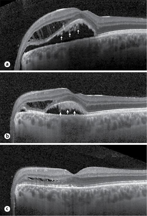 Natural Course of Optic Disc Pit Maculopathy: An Optical Coherence ...