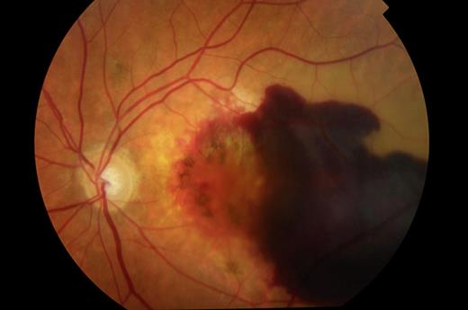 Current Management of Subretinal Hemorrhage in Neovascular Age-Related ...