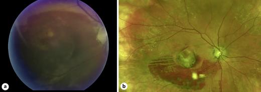 Current Management of Subretinal Hemorrhage in Neovascular Age-Related ...