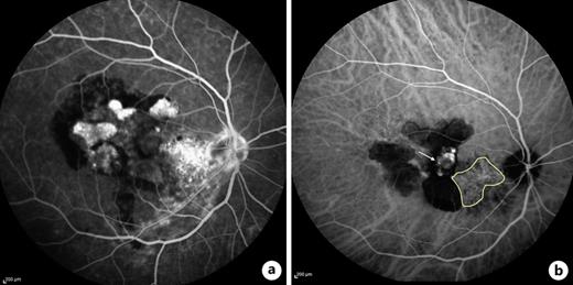 Displacement of Submacular Hemorrhage Using Subretinal Cocktail ...