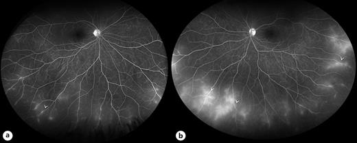 Diagnostic Workup of Retinal Vasculitis: An Algorithmic Approach ...