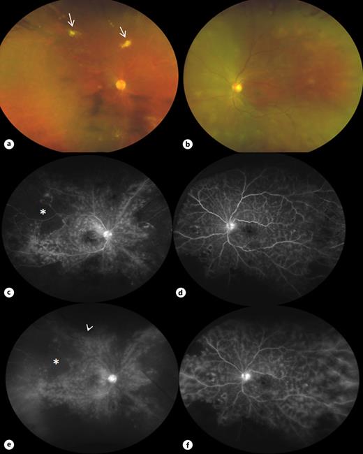 Diagnostic Workup of Retinal Vasculitis: An Algorithmic Approach ...