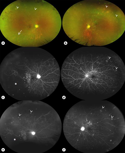 Diagnostic Workup of Retinal Vasculitis: An Algorithmic Approach ...