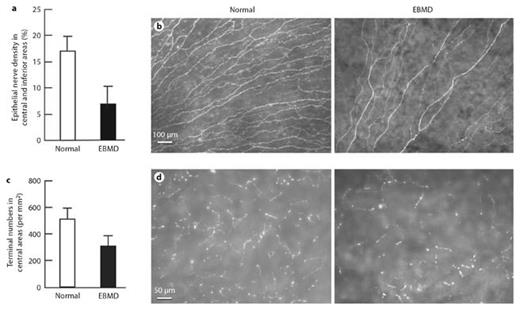 Corneal Nerve Architecture in a Donor with Unilateral Epithelial ...