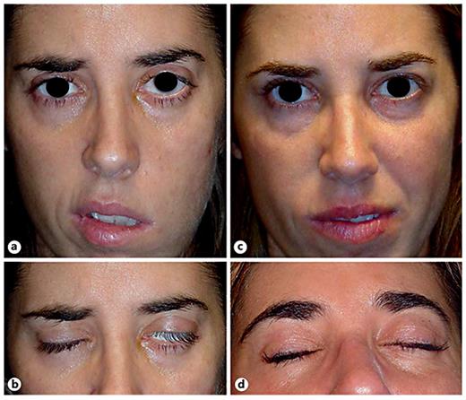 Lagophthalmos after Facial Palsy: Current Therapeutic Options ...