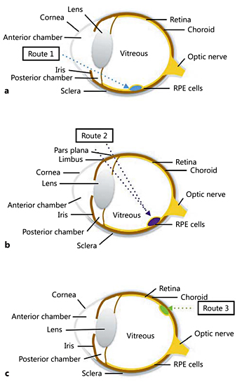 Subretinal Injection: A Review on the Novel Route of Therapeutic ...
