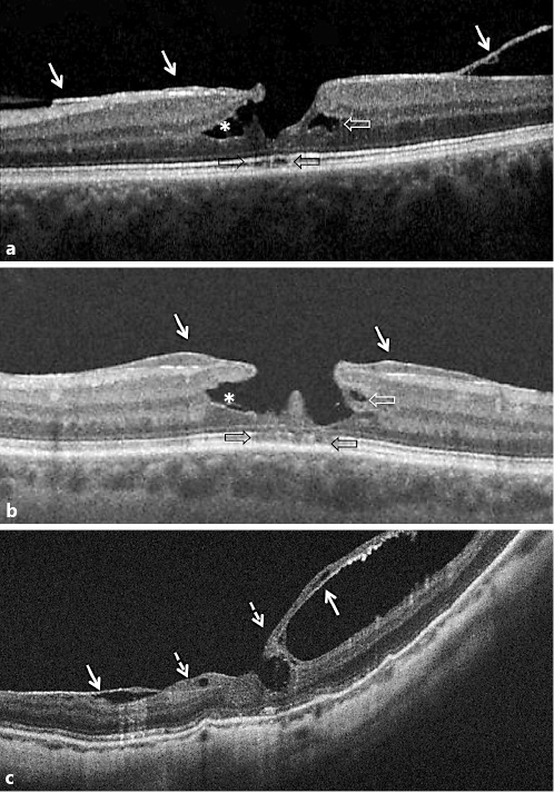Lamellar Macular Hole: State of the Art | Ophthalmic Research | Karger ...