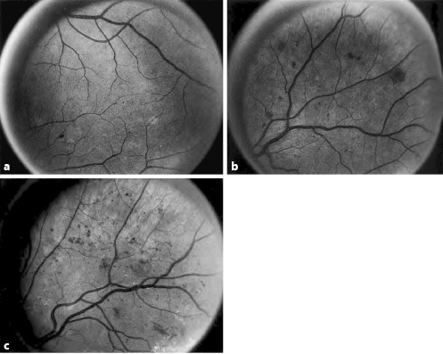ETDRS Grading of Diabetic Retinopathy: Still the Gold Standard ...