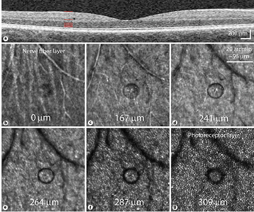 Life Cycle and Lensing of a Macular Microcyst | Ophthalmic Research ...