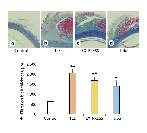 Evaluation of Bleb Characteristics after Trabeculectomy and Glaucoma ...