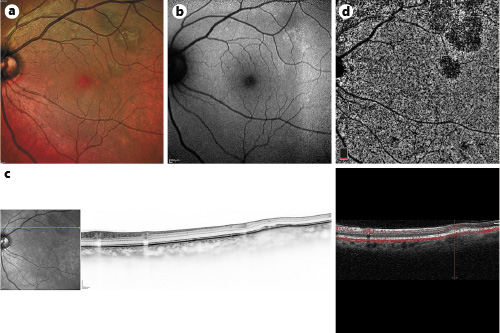 Multimodal Imaging in Choroidal Metastasis | Ophthalmic Research ...