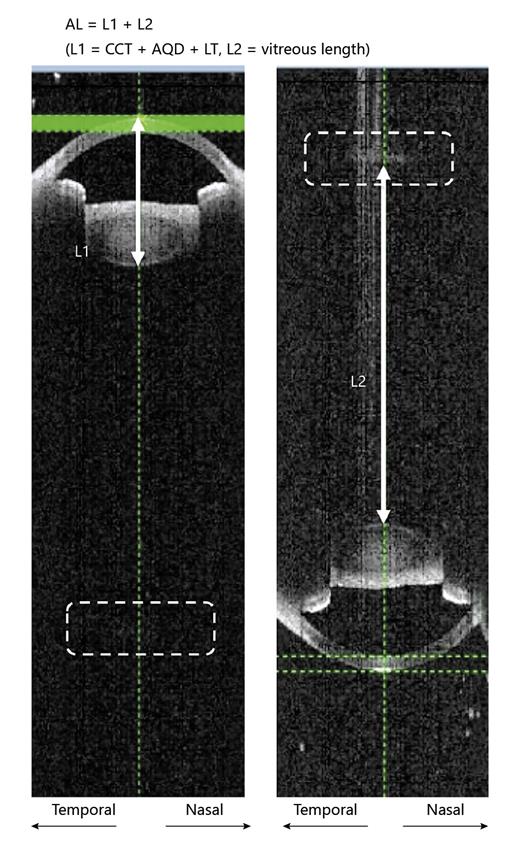 Evaluation of Axial Length Measurement Using Enhanced Retina ...