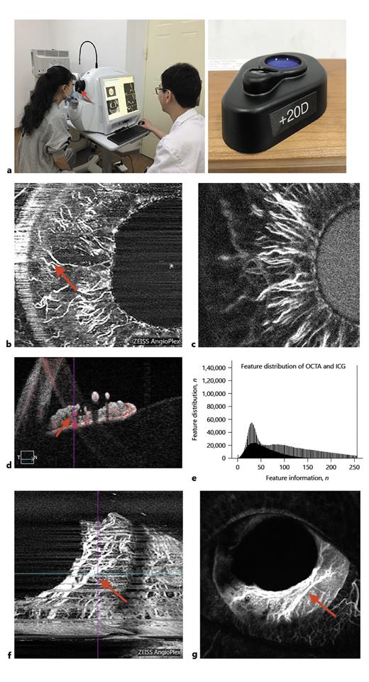 In vivo Noninvasive Imaging and Quantitative Analysis of Iris Vessels ...