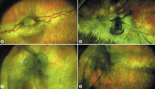 Intravitreal Tissue Plasminogen Activator Injection for the Treatment ...