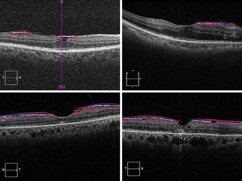 Automated Detection of Epiretinal Membranes in OCT Images Using Deep ...