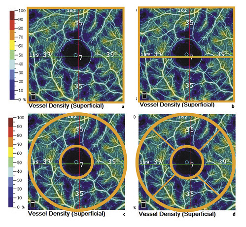 Faster Macular Vessel Density Loss in More Advanced Primary Open Angle ...