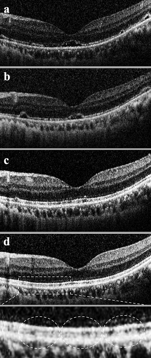 Structural and Functional Analysis of Multiple Subretinal Fluid Blebs ...