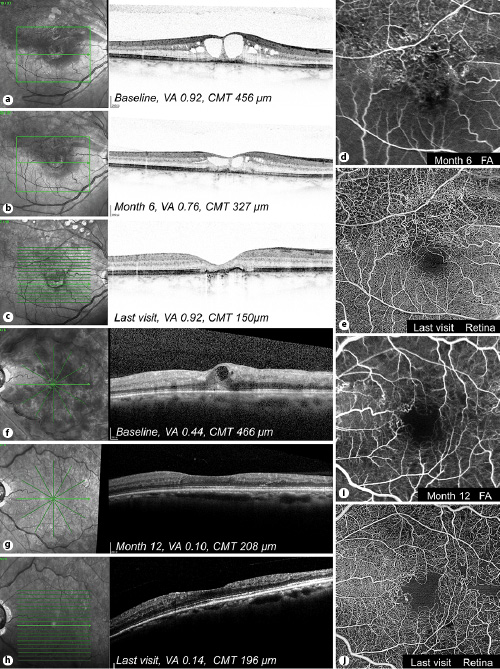 Intravitreal Dexamethasone Implant Has Better Retinal Perfusion than ...