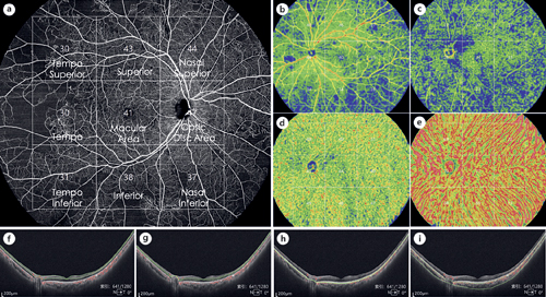 Comparison of Chorioretinal Parameters in Diabetic Retinopathy with or ...