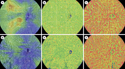 Comparison of Chorioretinal Parameters in Diabetic Retinopathy with or ...