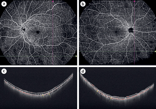 Comparison of Chorioretinal Parameters in Diabetic Retinopathy with or ...