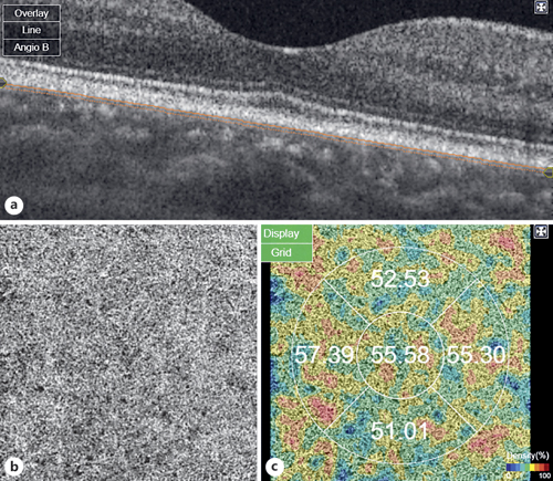 Macular Choroidal Thickness and Choriocapillaris Vessel Density ...