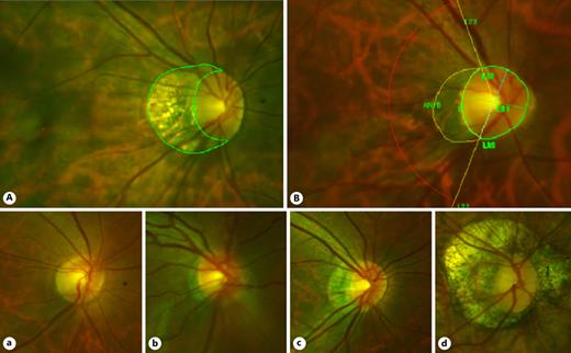 Distribution of the Retinal Microcirculation Based on the Morphology of ...