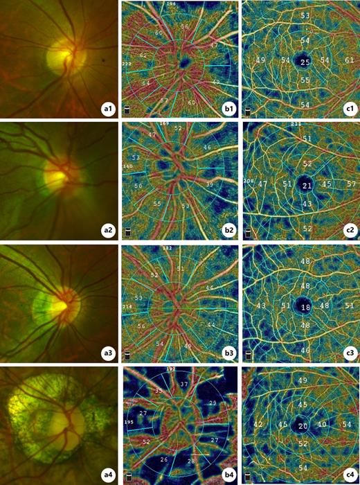 Distribution of the Retinal Microcirculation Based on the Morphology of ...